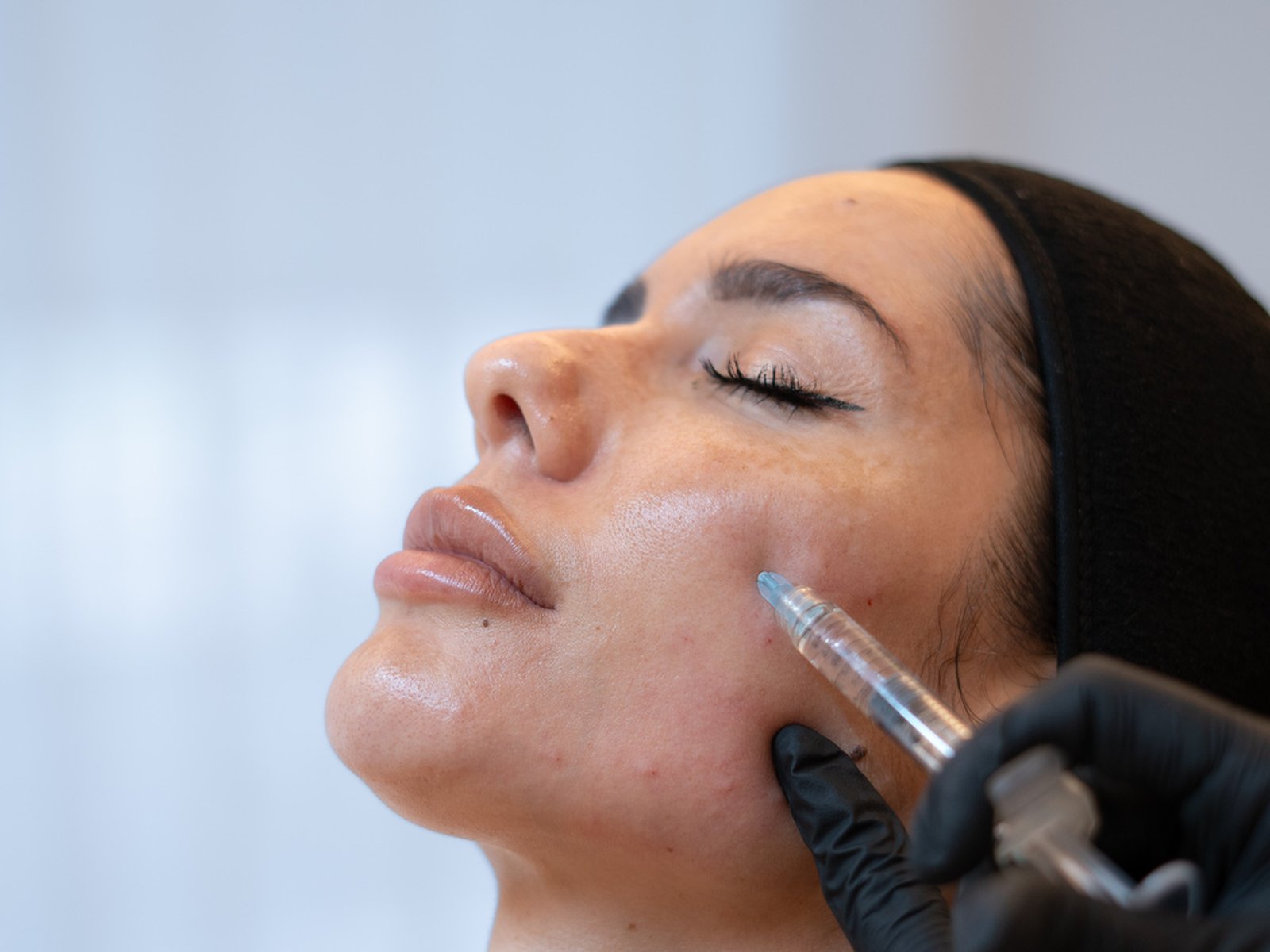 Skin Booster Treatment with Hyaluronic Acid, Vitamins, and Antioxidants